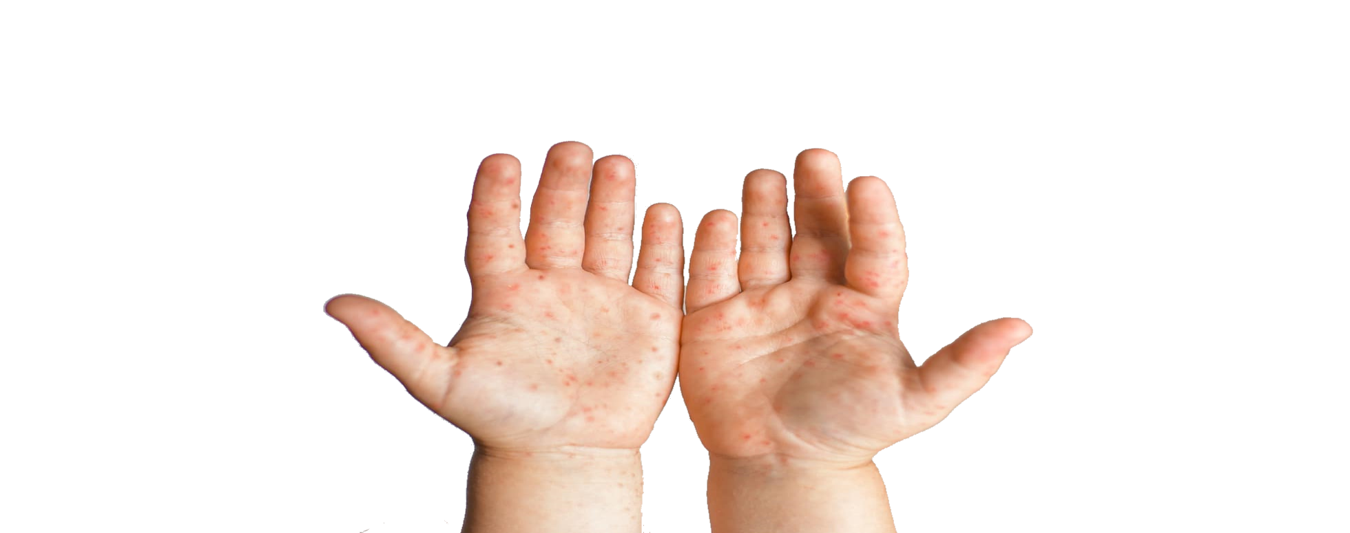 Hand Foot Mouth Disease HFMD, Punca Dan Cara Cegah